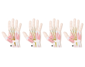 Anatomie - Karpaltunnelsyndrom – offene Karpaldachspaltung