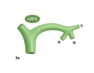 Anatomie - Leberresektion, linkslateral