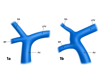Anatomie - Cholezystektomie, offen