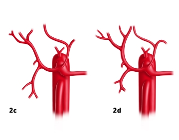 Anatomie - Lebersegmentresektion Segment VI