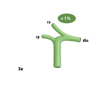 Anatomie - Lebersegmentresektion Segment VI
