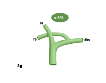 Anatomie - Lebersegmentresektion Segment VI